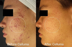 Blue & Red LED Light Therapy Acne Treatment | Celluma